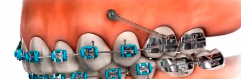 ¿Qué son los microtornillos de ortodoncia? - Ortoimplants Premium